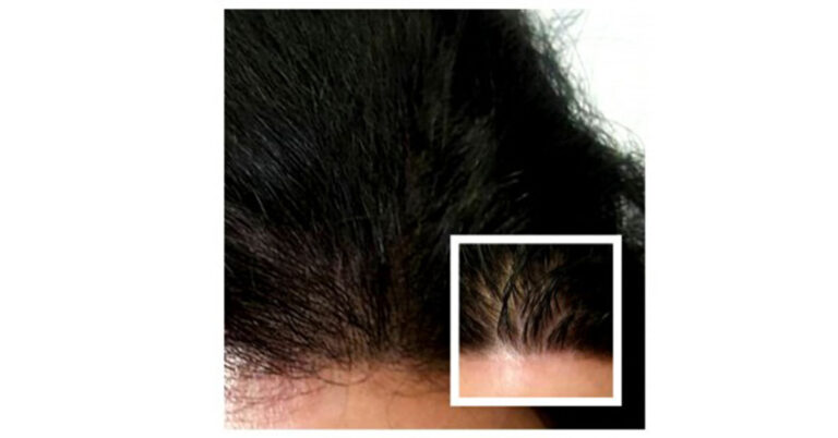 Got Uneven Hairline? Here’s What You Can Do