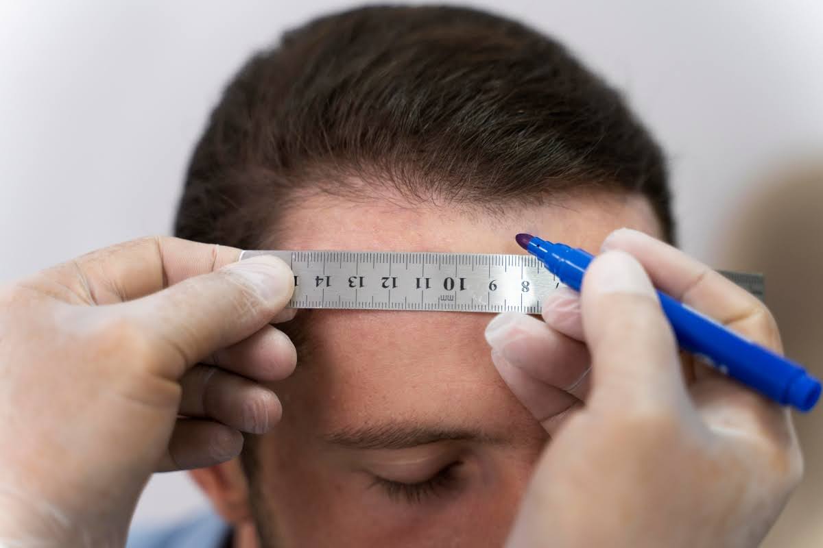 Scalp Micropigmentation Fading: Longevity & Maintenance